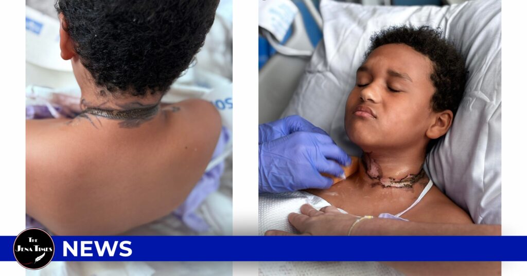 Jena Child Burned in Freak Accident - The Jena Times